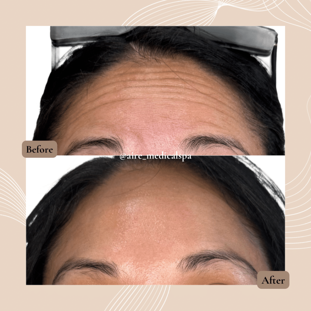 Wrinkle Relaxers North Hollywood - Botox Studio City CA